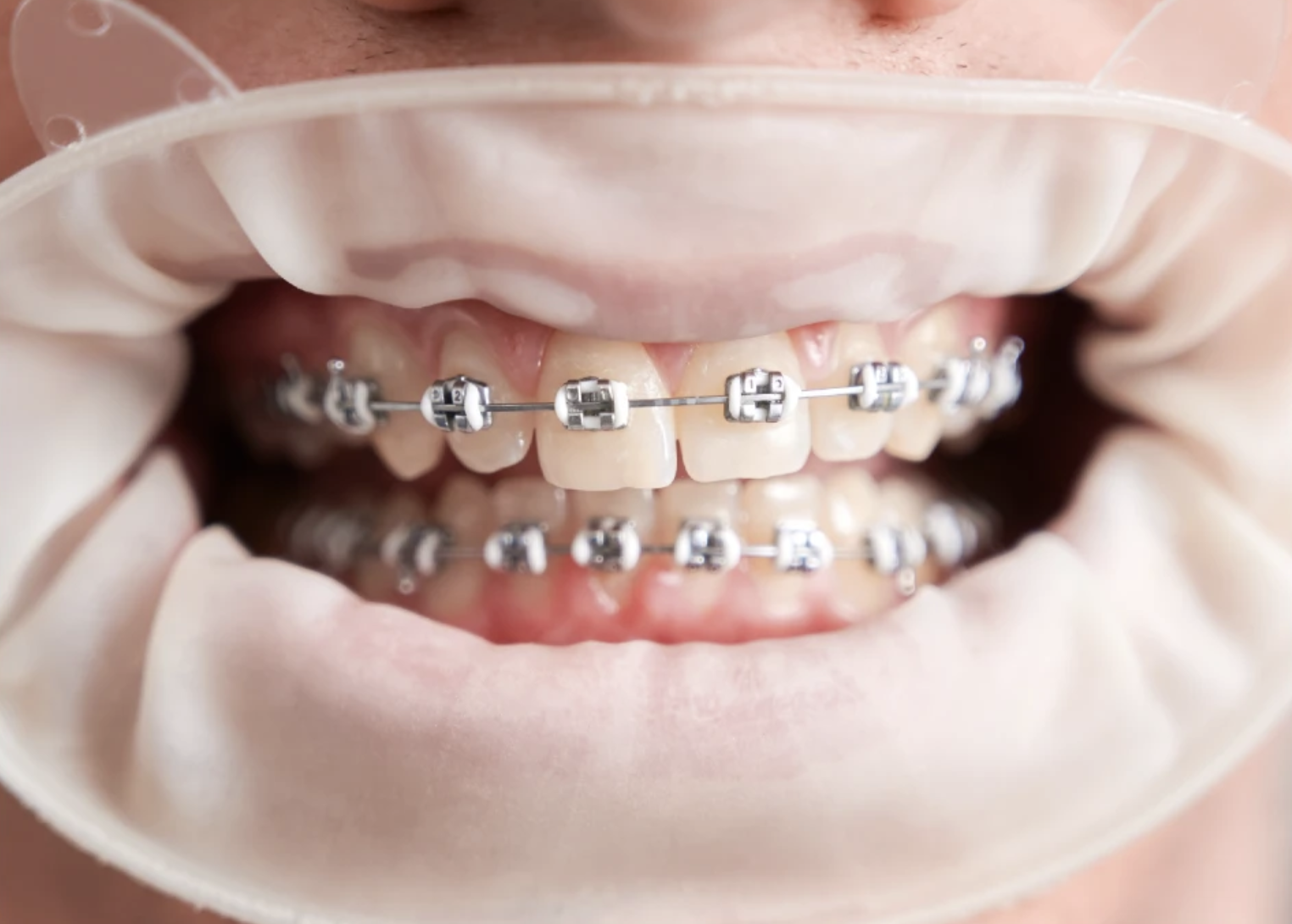 Prosthodontics – Dr. Pipat's Clinic